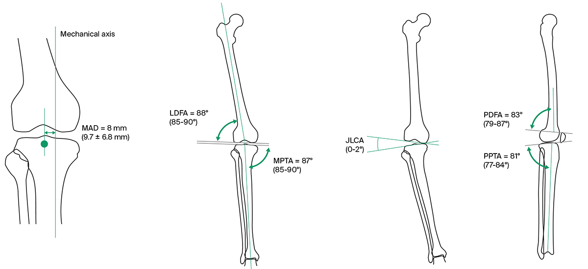 Osteotomy prior to total knee arthroplasty: optimizing limb alignment
